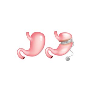 Bariatric Surgery in Mexico - Safe Weight Loss | ALO Bariatrics
