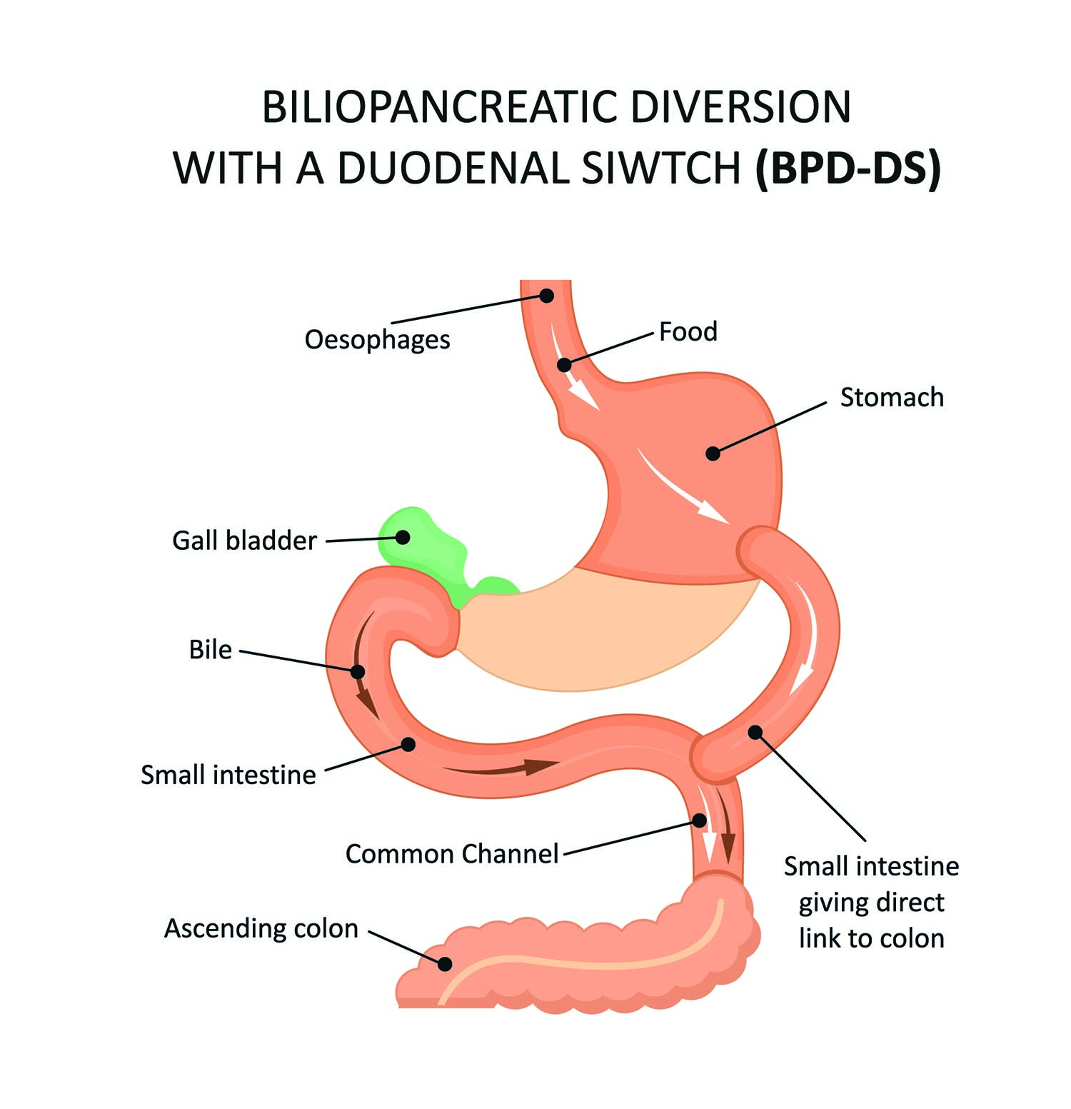 Duodenal Switch vs Gastric Bypass: Key Differences Explained Duodenal Switch vs Gastric Bypass: Key Differences Explained