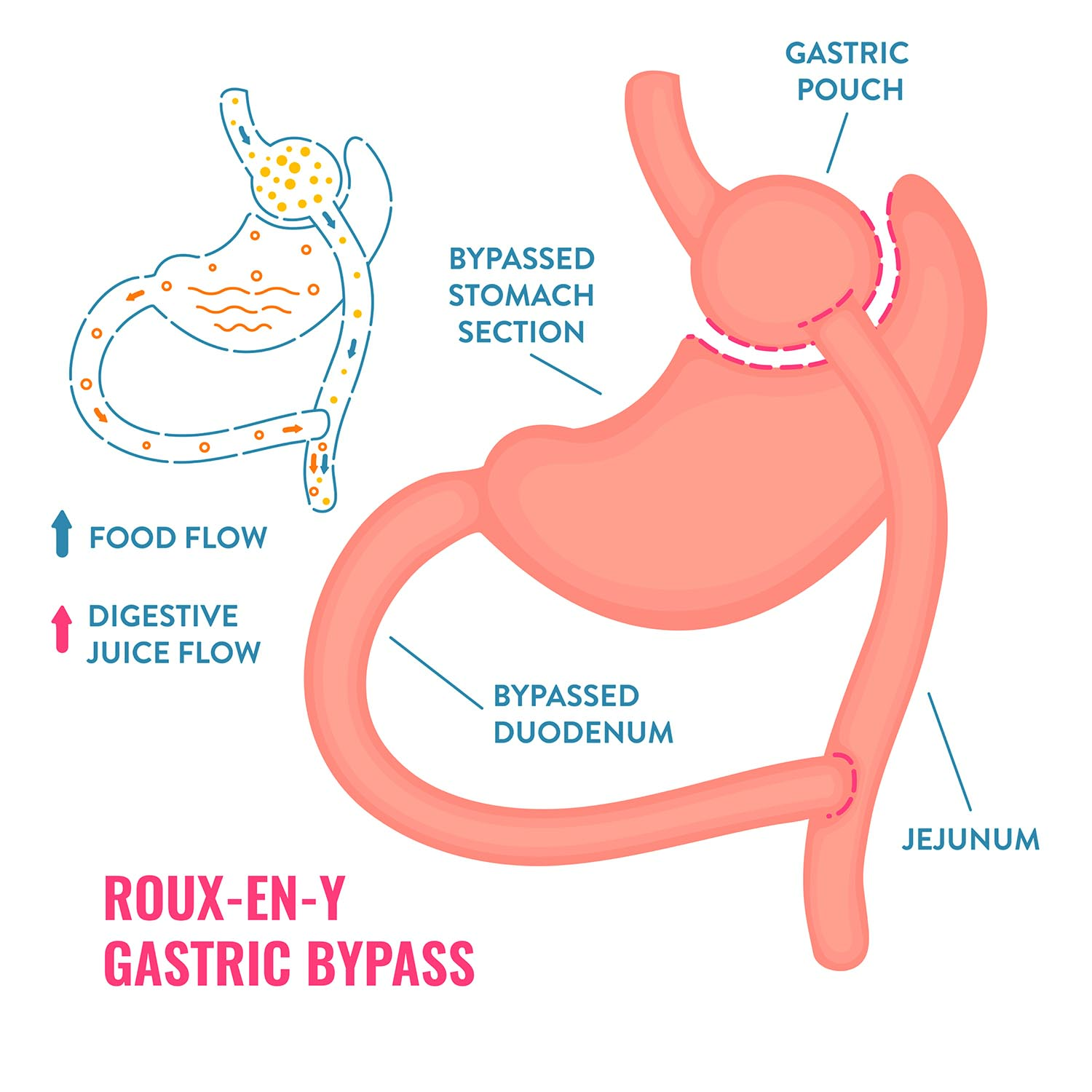 Duodenal Switch vs Gastric Bypass: Key Differences Explained Duodenal Switch vs Gastric Bypass: Key Differences Explained