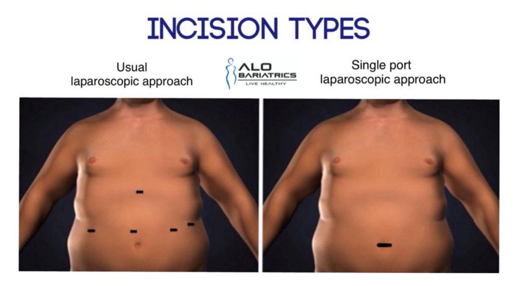 SILS Tijuana, Mexico: Single Incision Laparoscopic Surgery